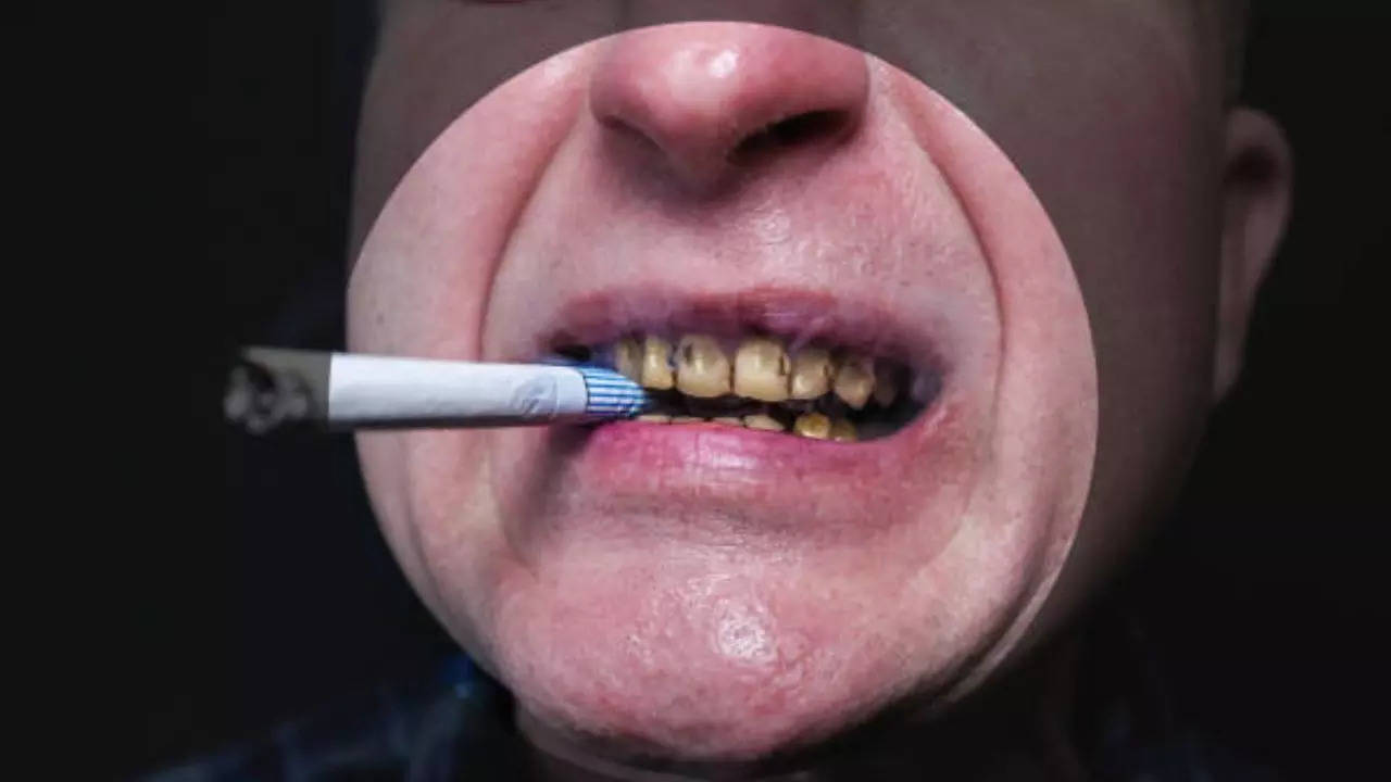 No Smoking Day 2025: This Is How Smoking Destroys Your Teeth—And It’s ...