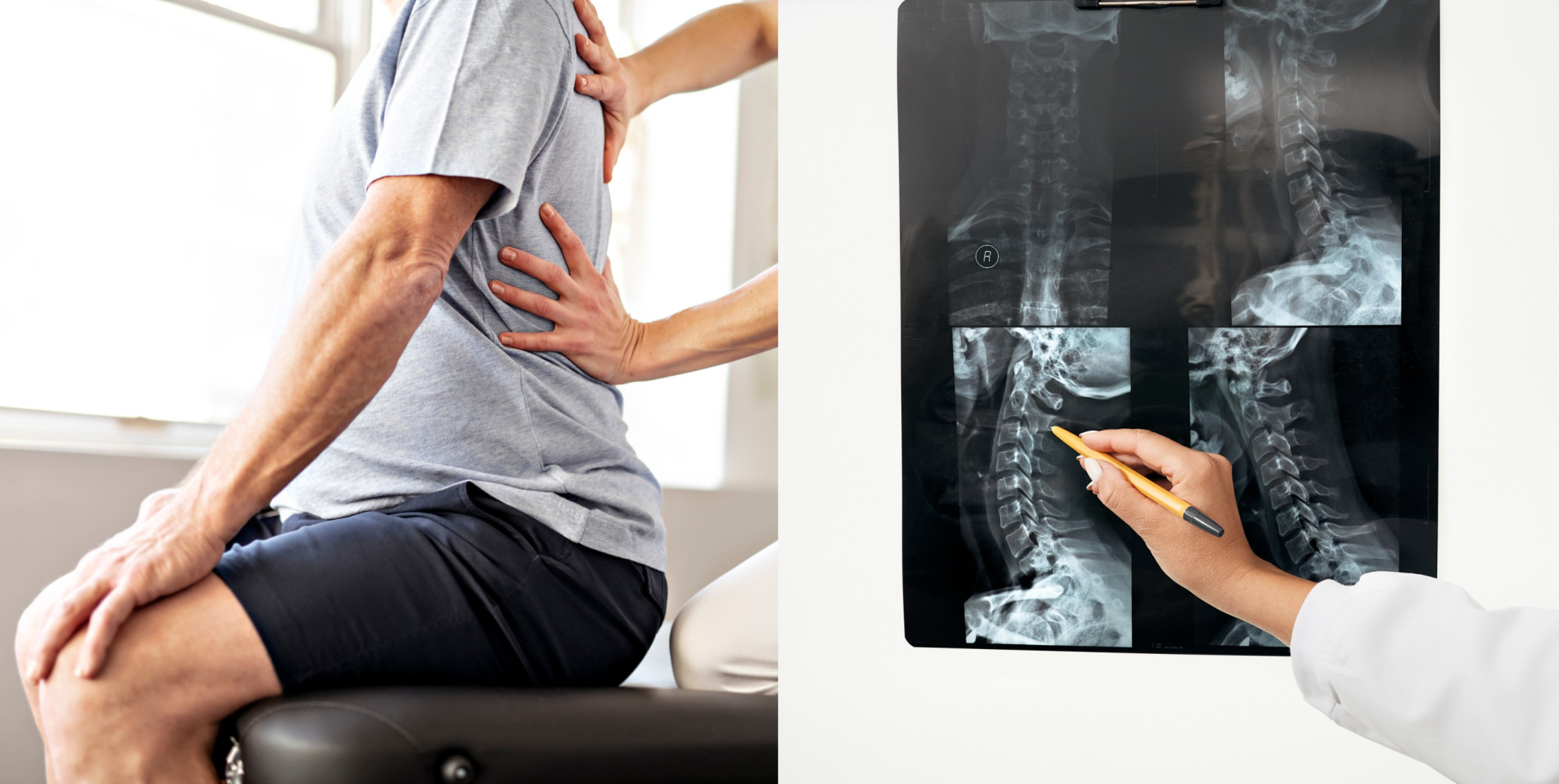 Syringomyélie : causes, symptômes et traitement de ce trouble neurologique