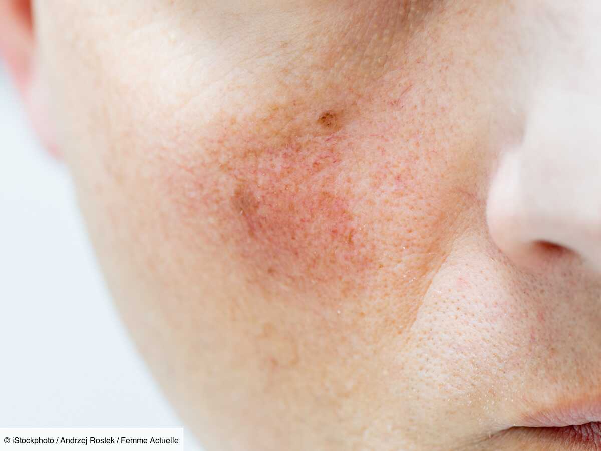 Votre rosacée vous mène la vie dure ? L'astuce étonnante d'une ...