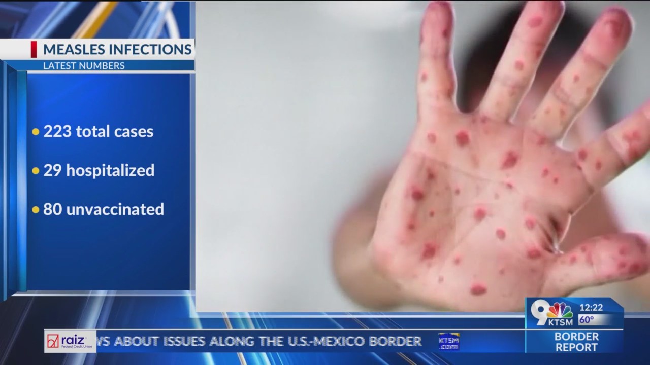 The latest on measles outbreak in Texas