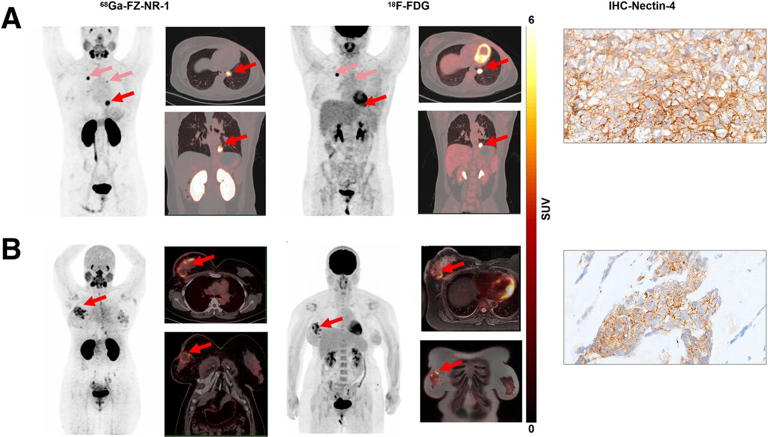 Novel radiotracer identifies biomarker for triple-negative breast cancer