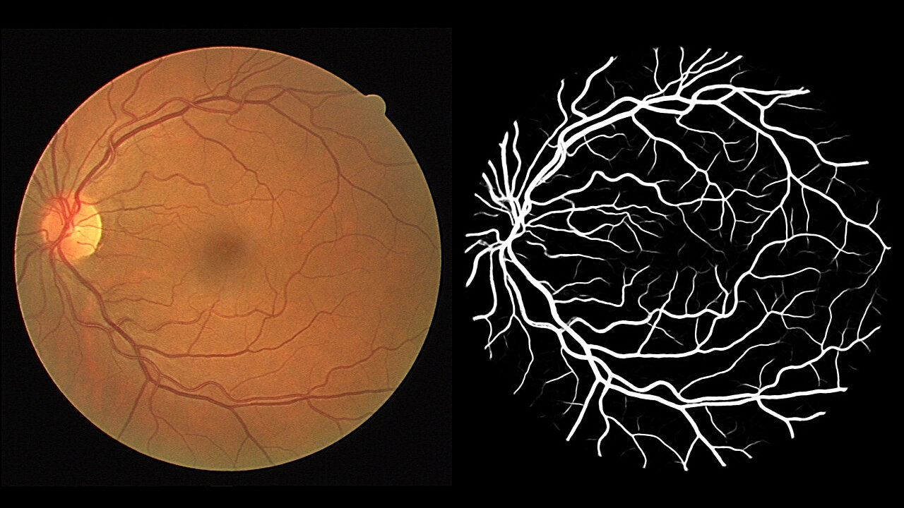 AI maps blood vessels in the retina for better diagnostics