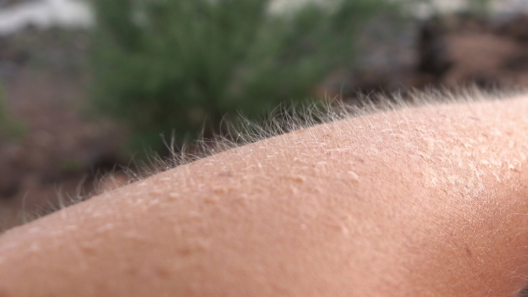 Goosebumps Aren’t Just About Cold, Then What Are They?