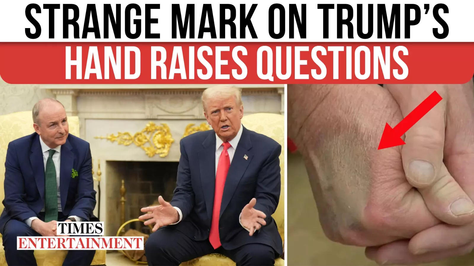 Trump’s Hand Shows STRANGE Bruise; Make-Up or Health Scare? Experts ...