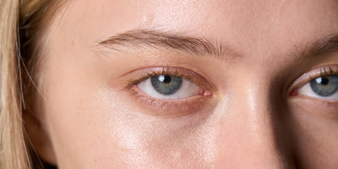 How I Beat Adult Acne—And Learned About The Pervasive Nature Of Skin ...