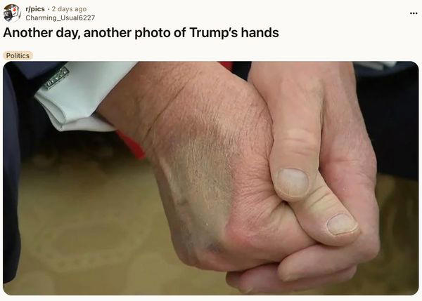 What we know about the apparent bruise on Trump's hand