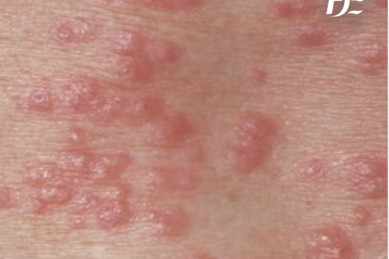 HSE issues warning on 'highly contagious' scabies burrowing skin mites ...