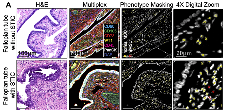 Major discovery identifies the cause of ovarian cancer