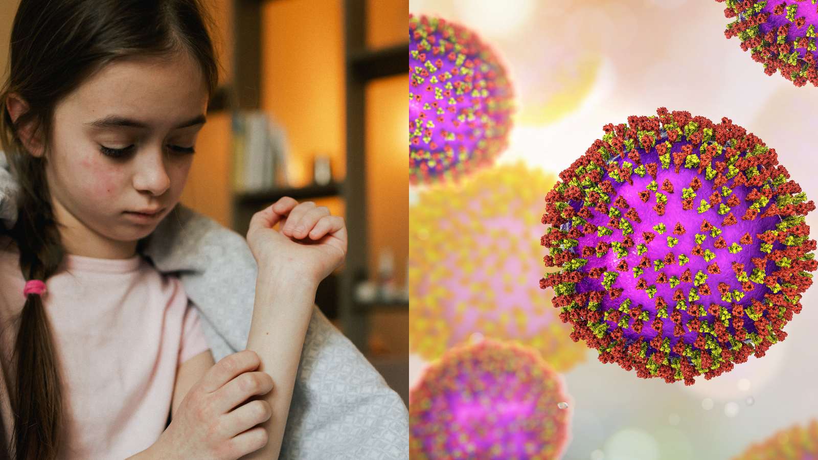 Measles outbreak in USA claims one life: Know symptoms and how to ...