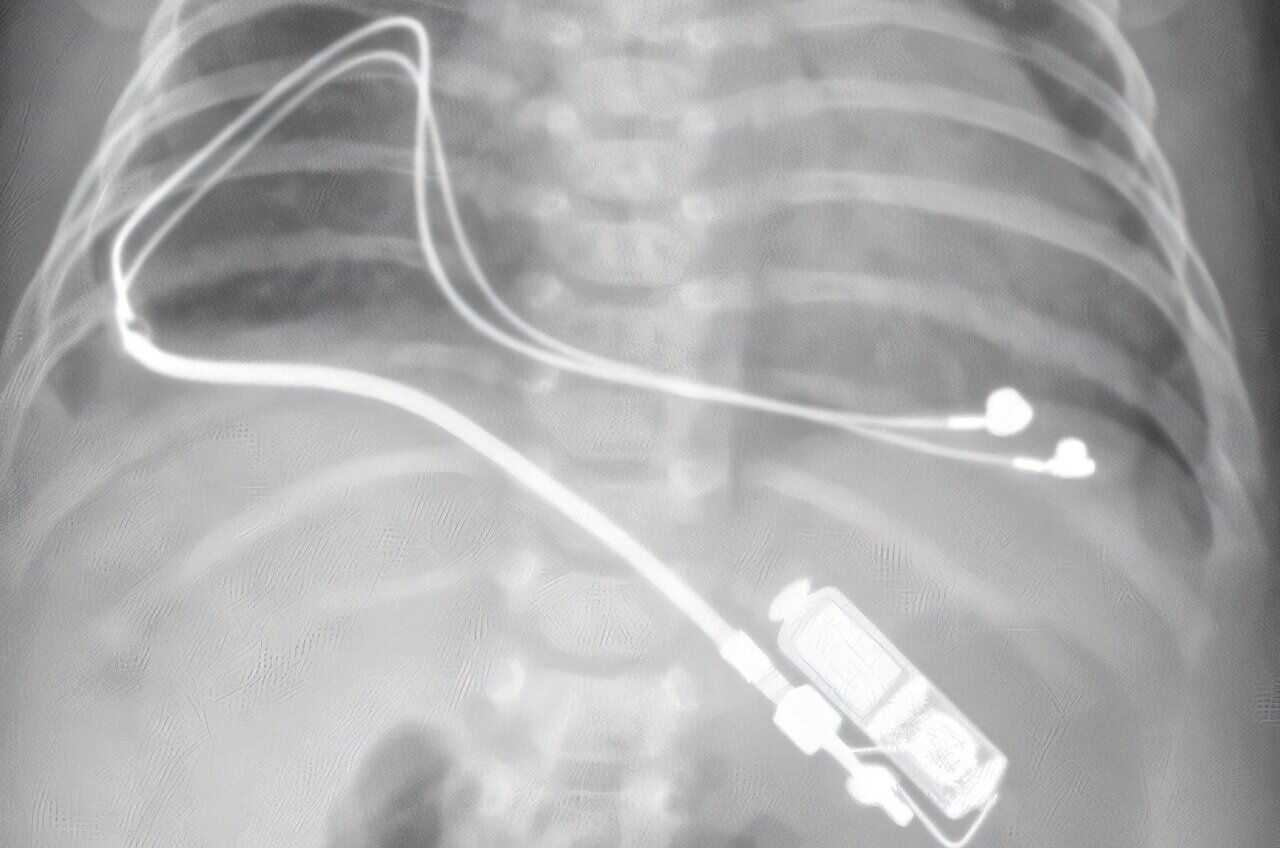 Tiny pacemakers can safely stabilize newborns' hearts for up to two years