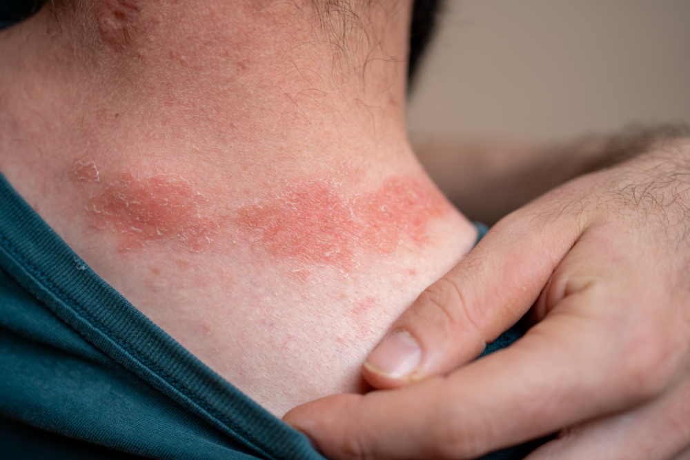 The new skin infection spreading across the UK faster than doctors expected