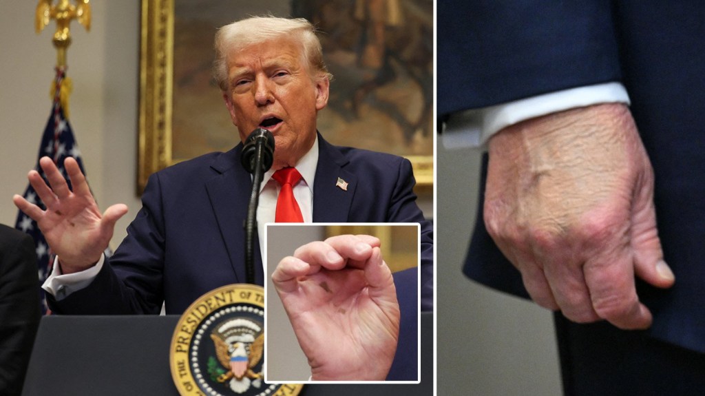 What’s going on with President Trump’s hands? New marks appear days ...