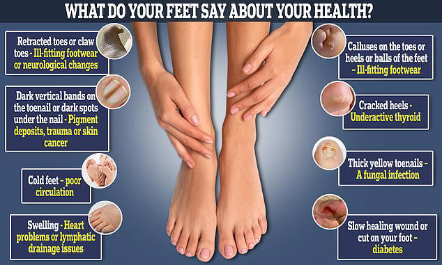 Why you need to check if you have an 'Irish pinky toe'