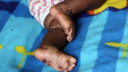 Monkeypox Explainer