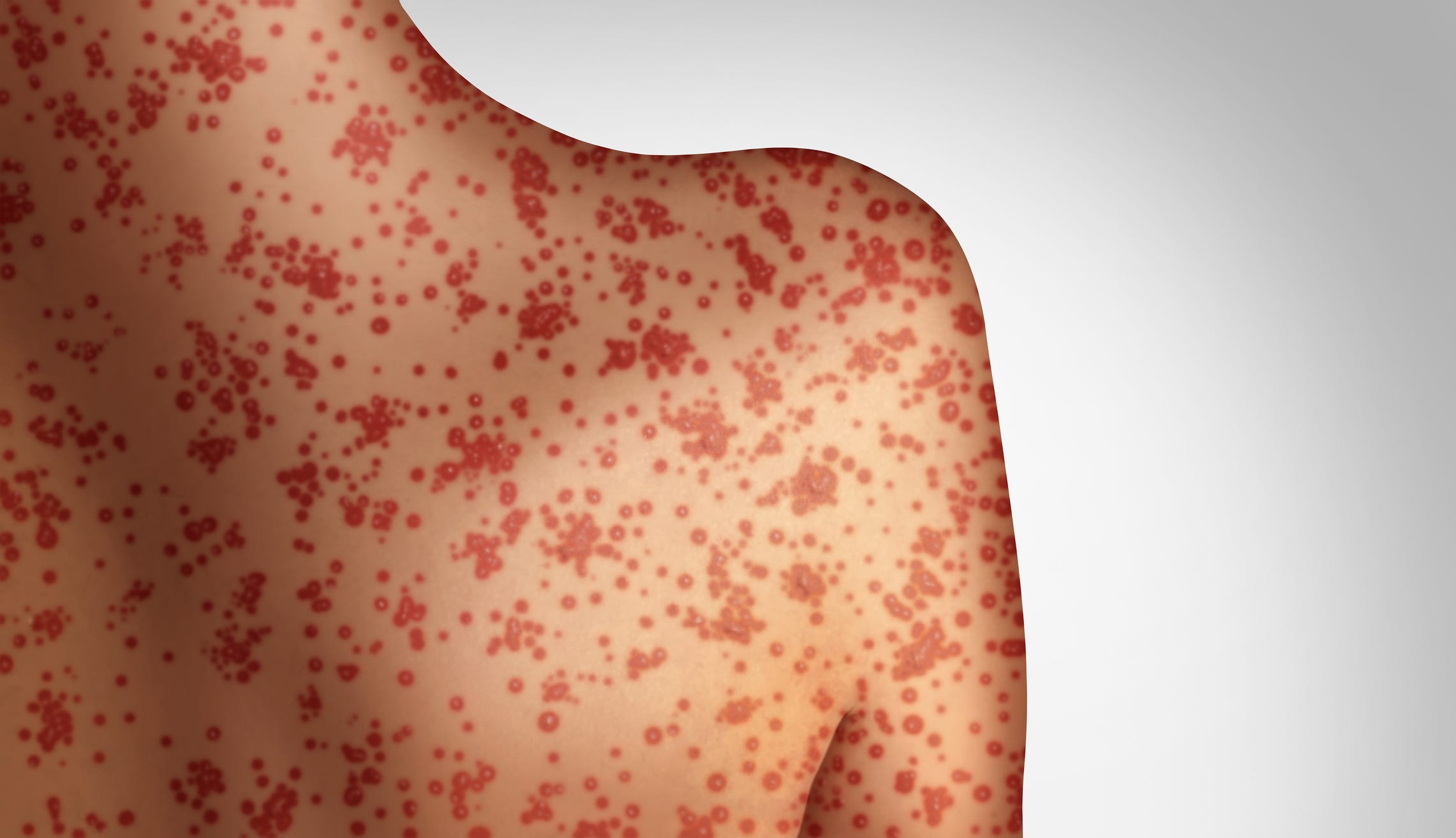 Second measles death reported in Texas. What to know as outbreak continues