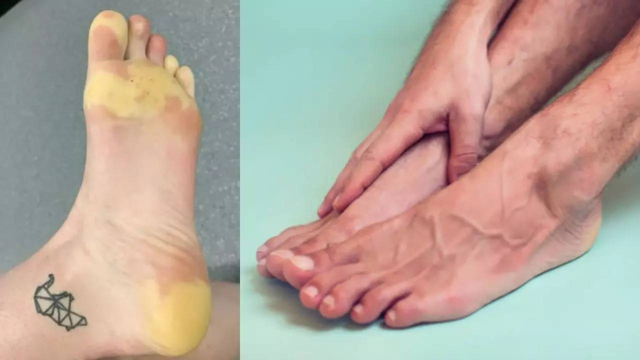 Woman's Feet Turn Yellow Due to High-level Stress Caused by a ...