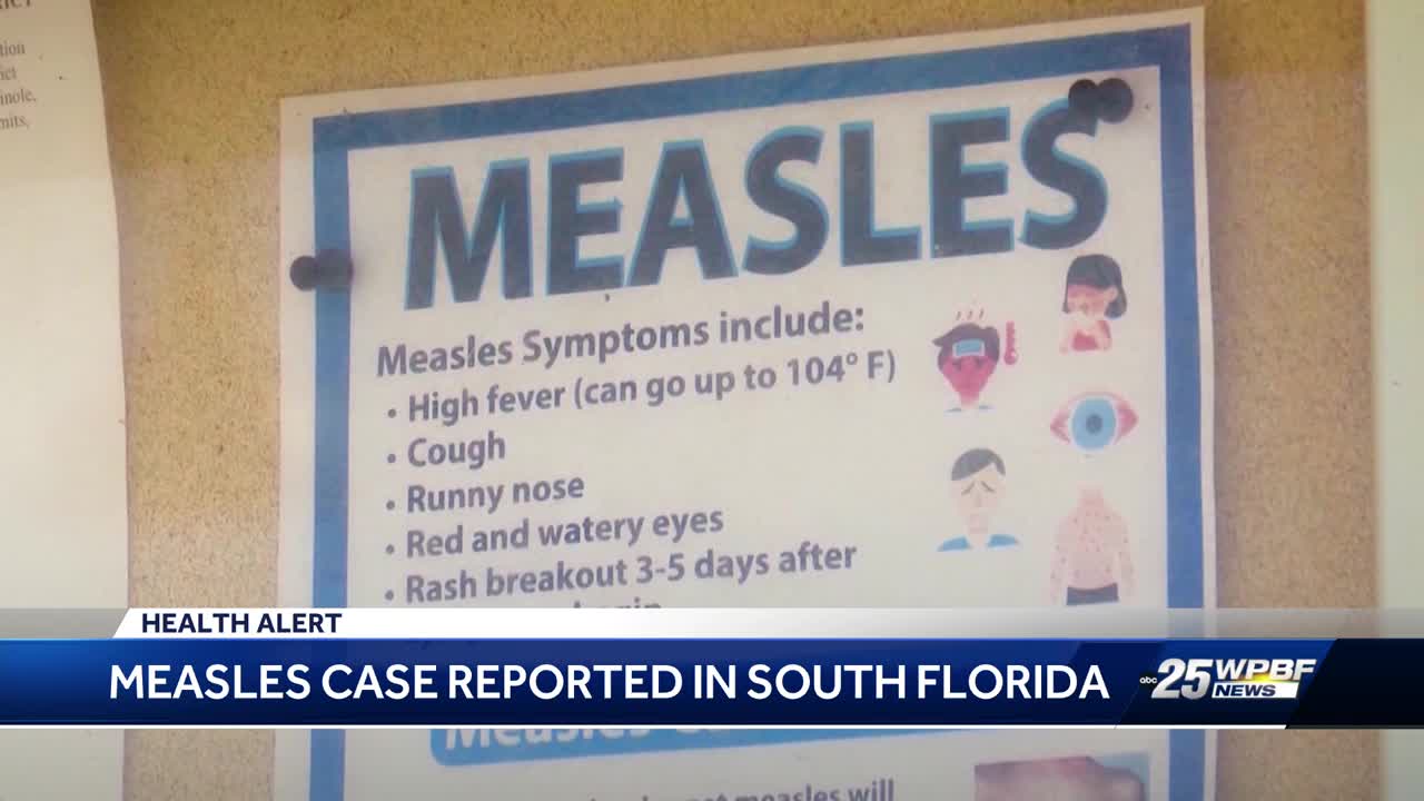 Measles case confirmed in South Florida