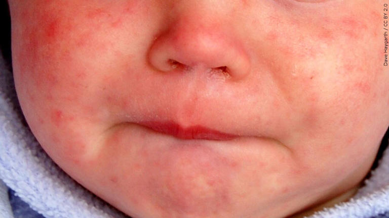 Sanford addresses measles outbreak