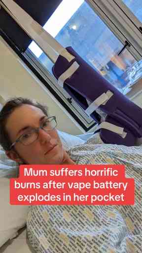 Mum Suffers Horrific Burns After Vape Battery Explodes in Her Pocket