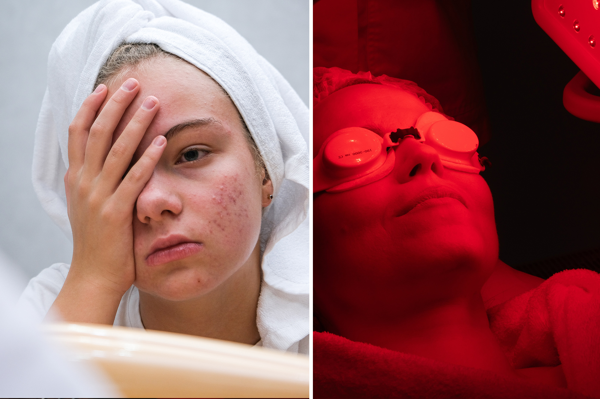 Can at-home red-light therapy really cure acne? New study puts LED ...