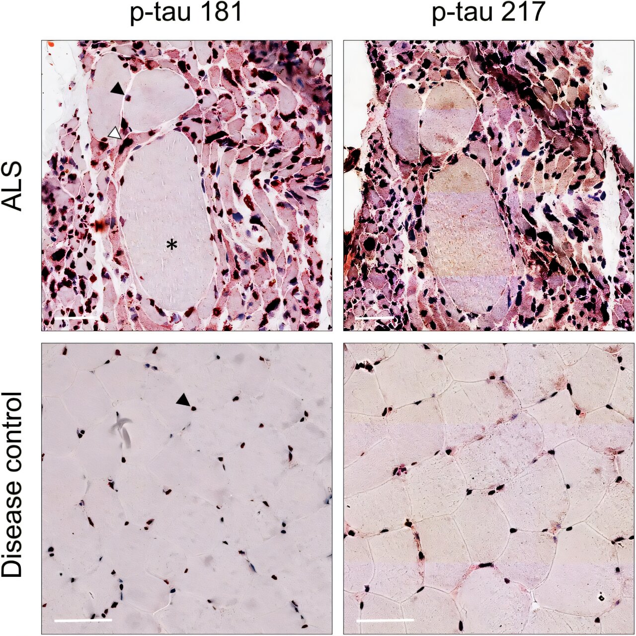 Diagnosing Alzheimer's disease using blood tests—p-tau biomarkers not ...