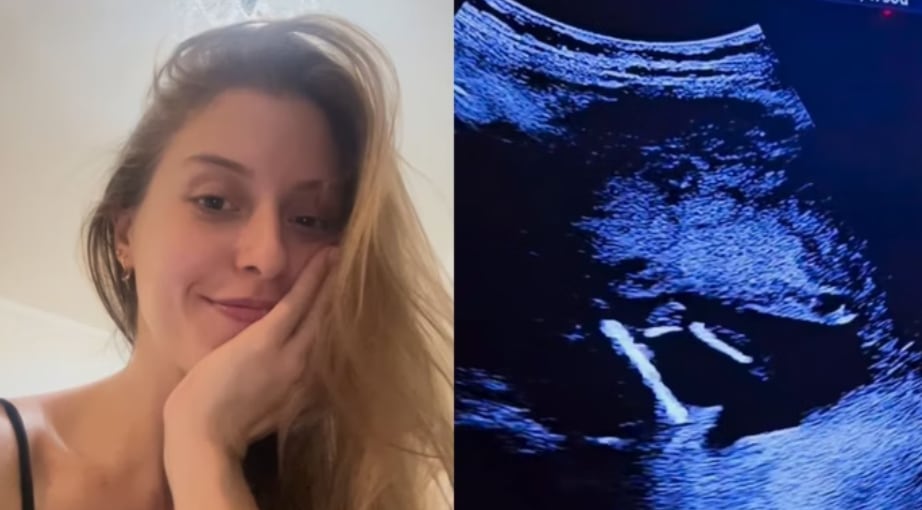 Grávida viraliza ao mostrar bebê chutando DIU durante ultrassom: ‘Será ...
