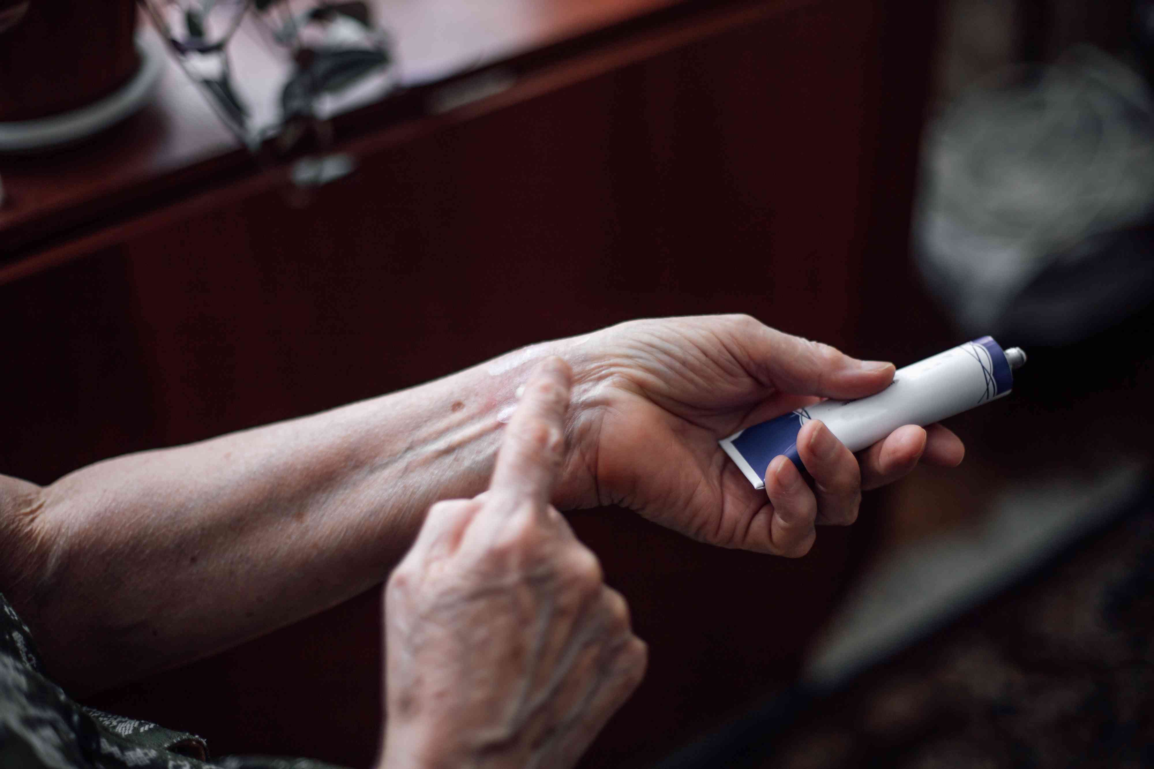 7 At-Home Treatments to Clear Ringworm Quickly