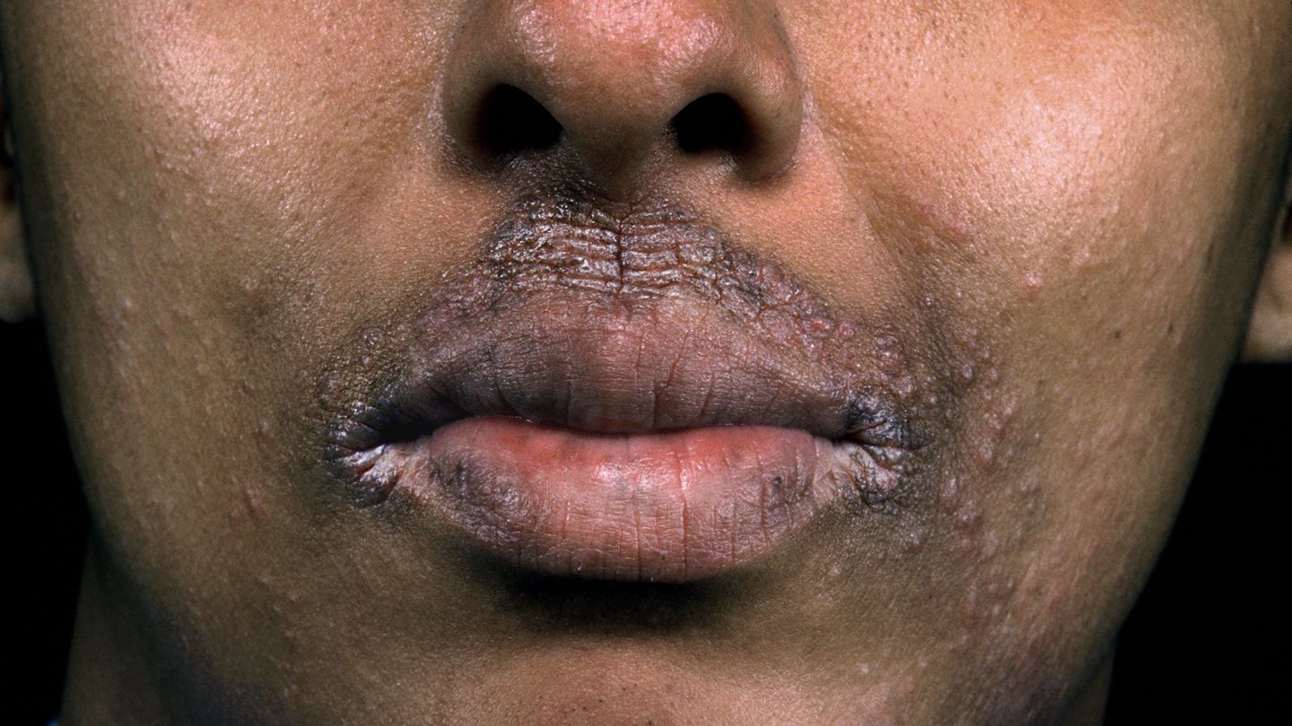 What to Do When Atopic Dermatitis Causes Dark Patches or Light Spots on ...