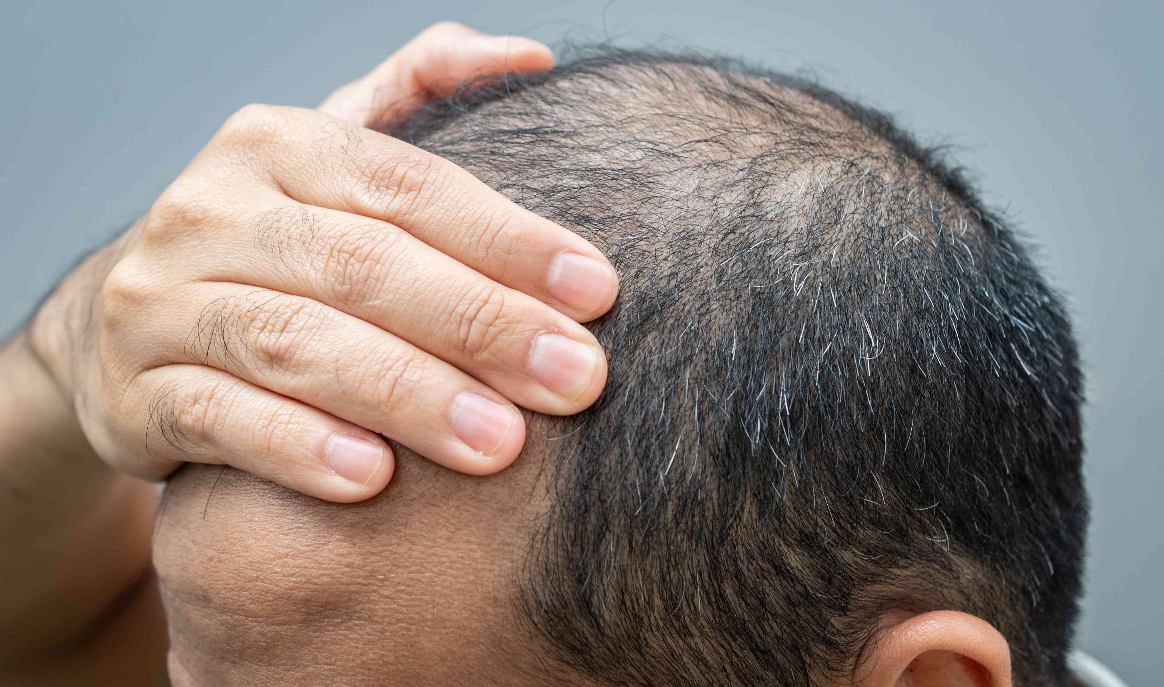 Is Male- or Female-Pattern Baldness Reversible?