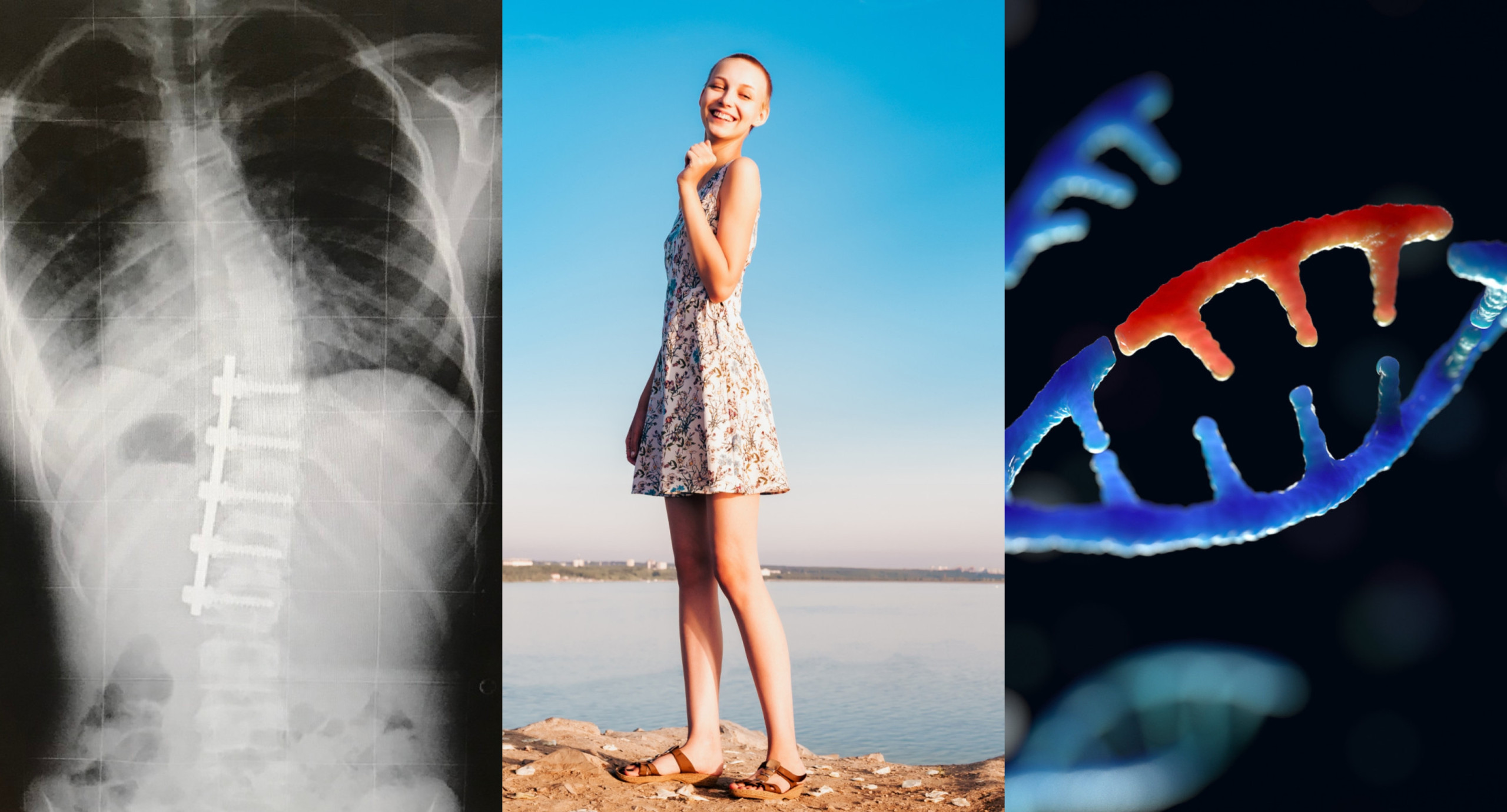 Quand être grand et mince peut être synonyme de mauvaises nouvelles