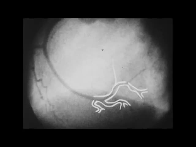 Normal Heart Anatomy: X-Ray Fluoroscopy & Blood Flow Analysis