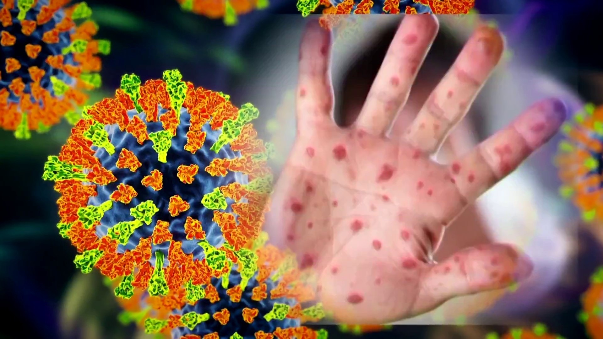 Second unvaccinated person dies of suspected measles