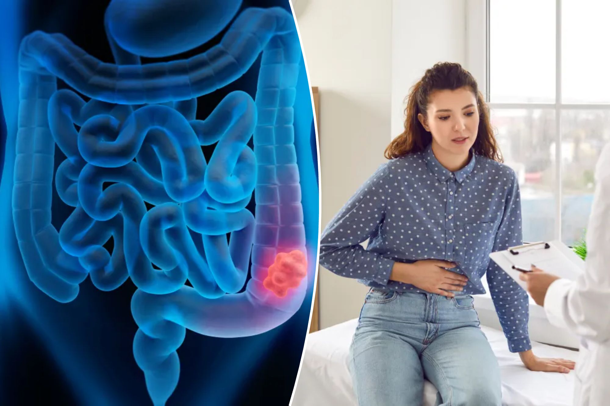 Why colorectal cancer is often only caught when it’s in late stages ...