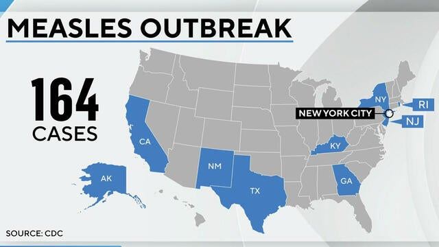 Measles outbreak spreads as experts warn of lasting immune effects