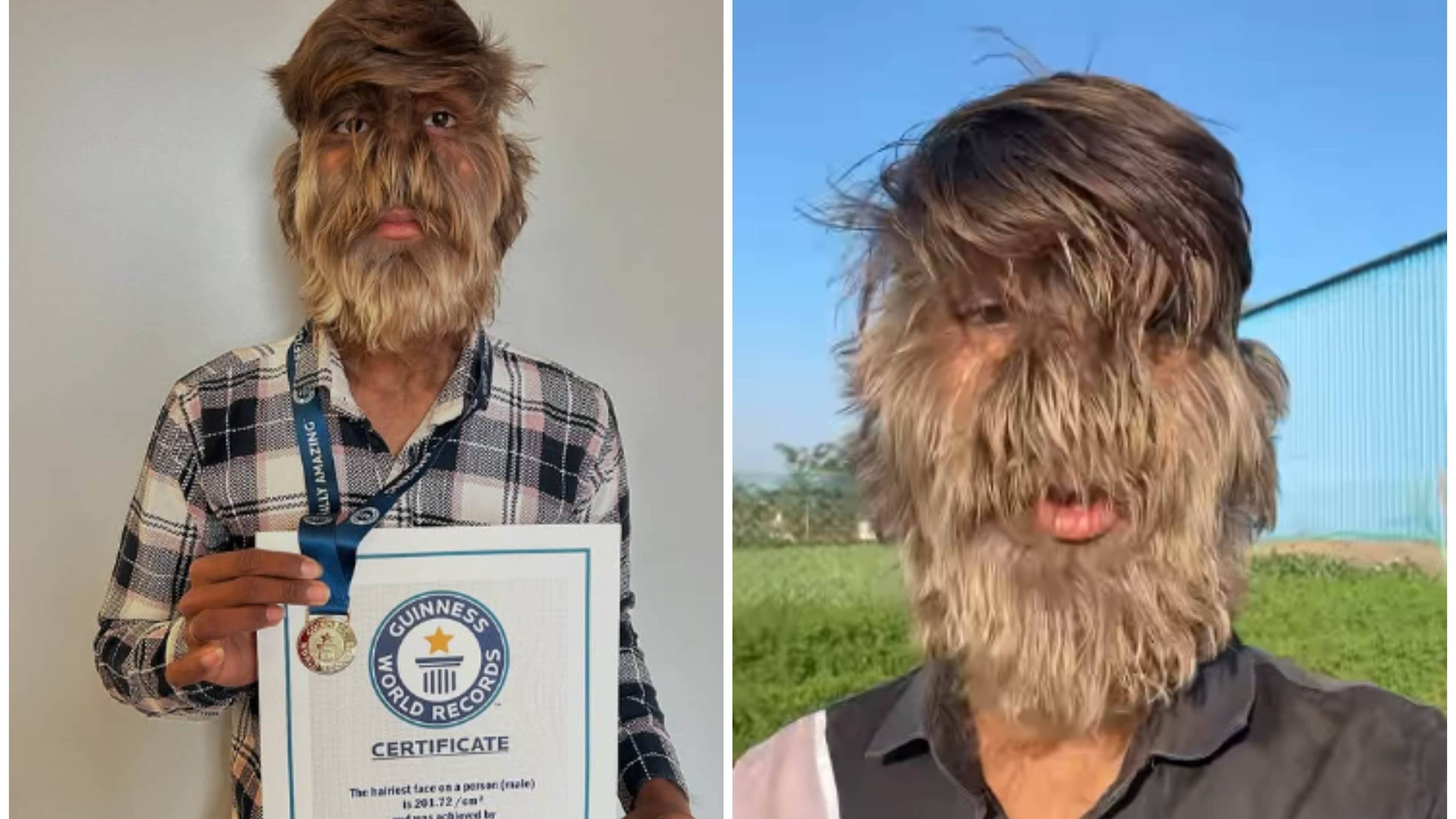 This 18-Year-Old with ‘Werewolf Syndrome’ Just Made Guinness World ...
