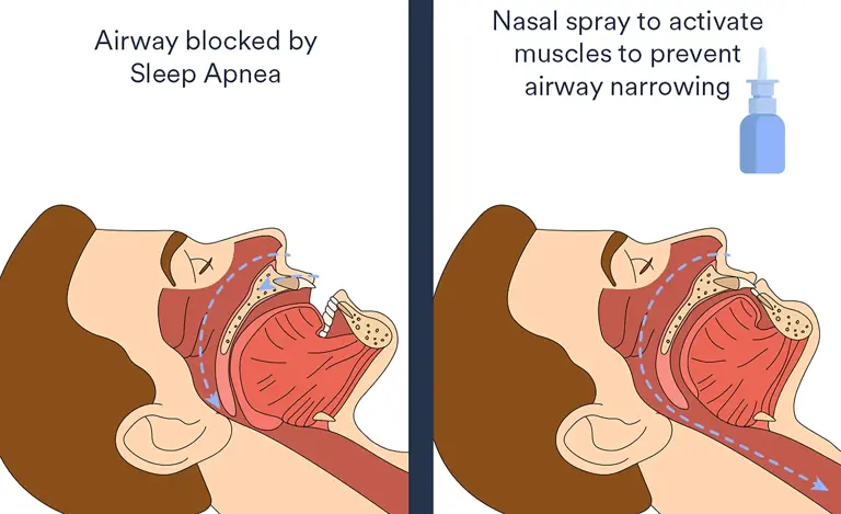 New nighttime nasal spray significantly alleviates sleep apnea