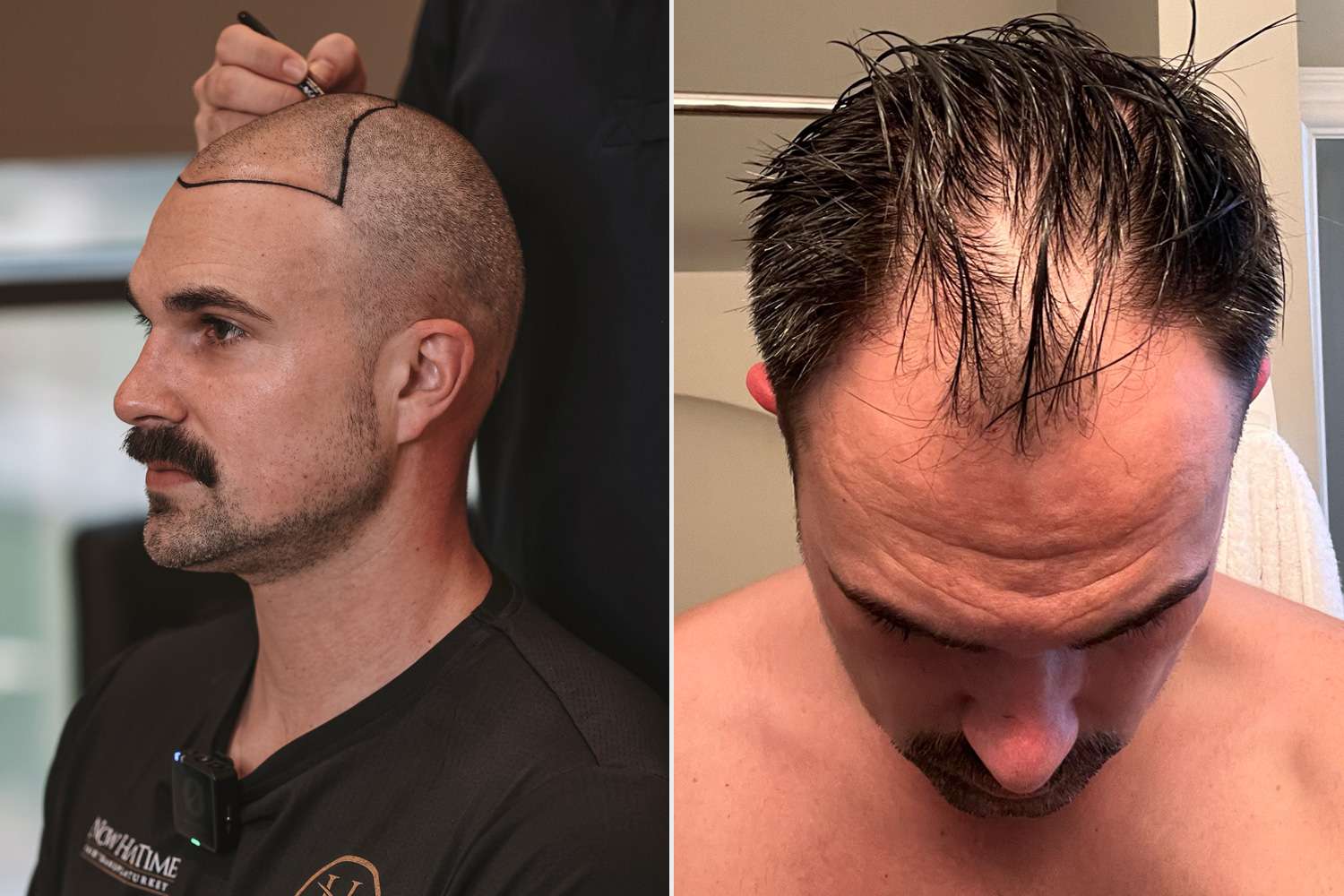 Man, 34, 'Wanted a Nicer Hairline' So He Got a Hair Transplant in ...