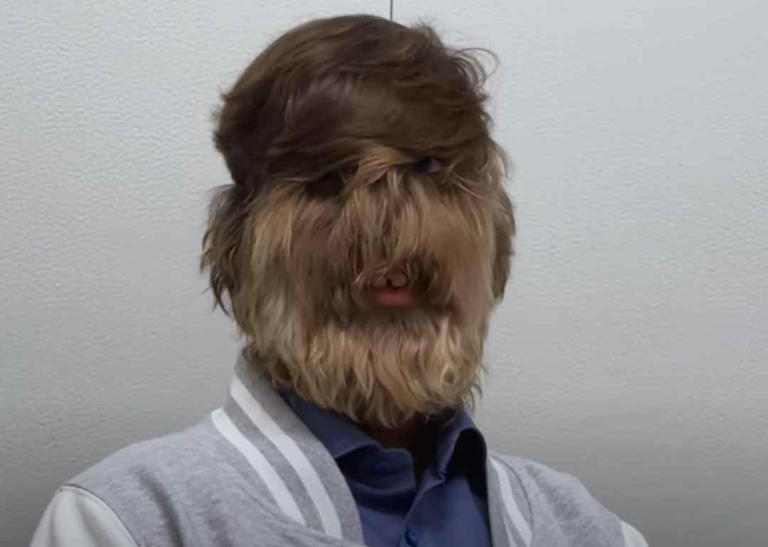 World's hairiest-faced man shares his journey with hypertrichosis