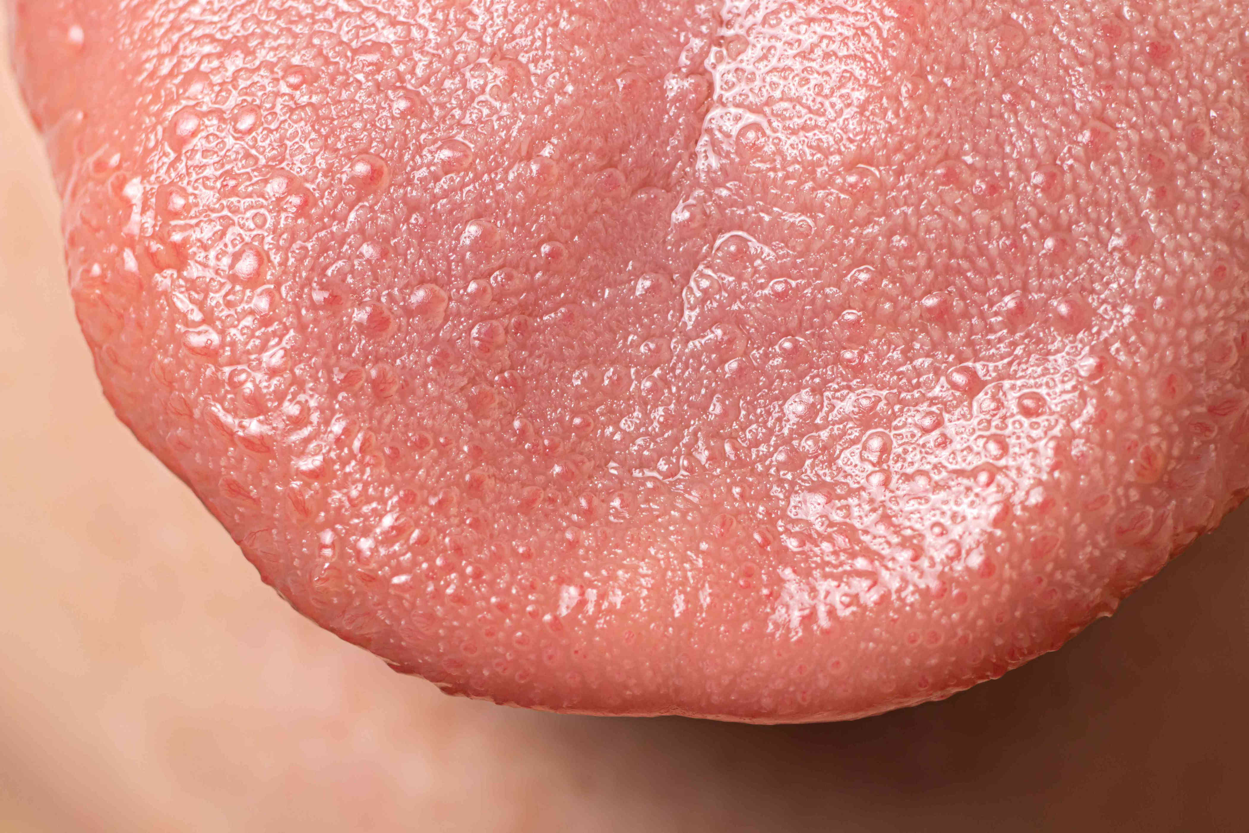 What Causes Bumps on Your Tongue?