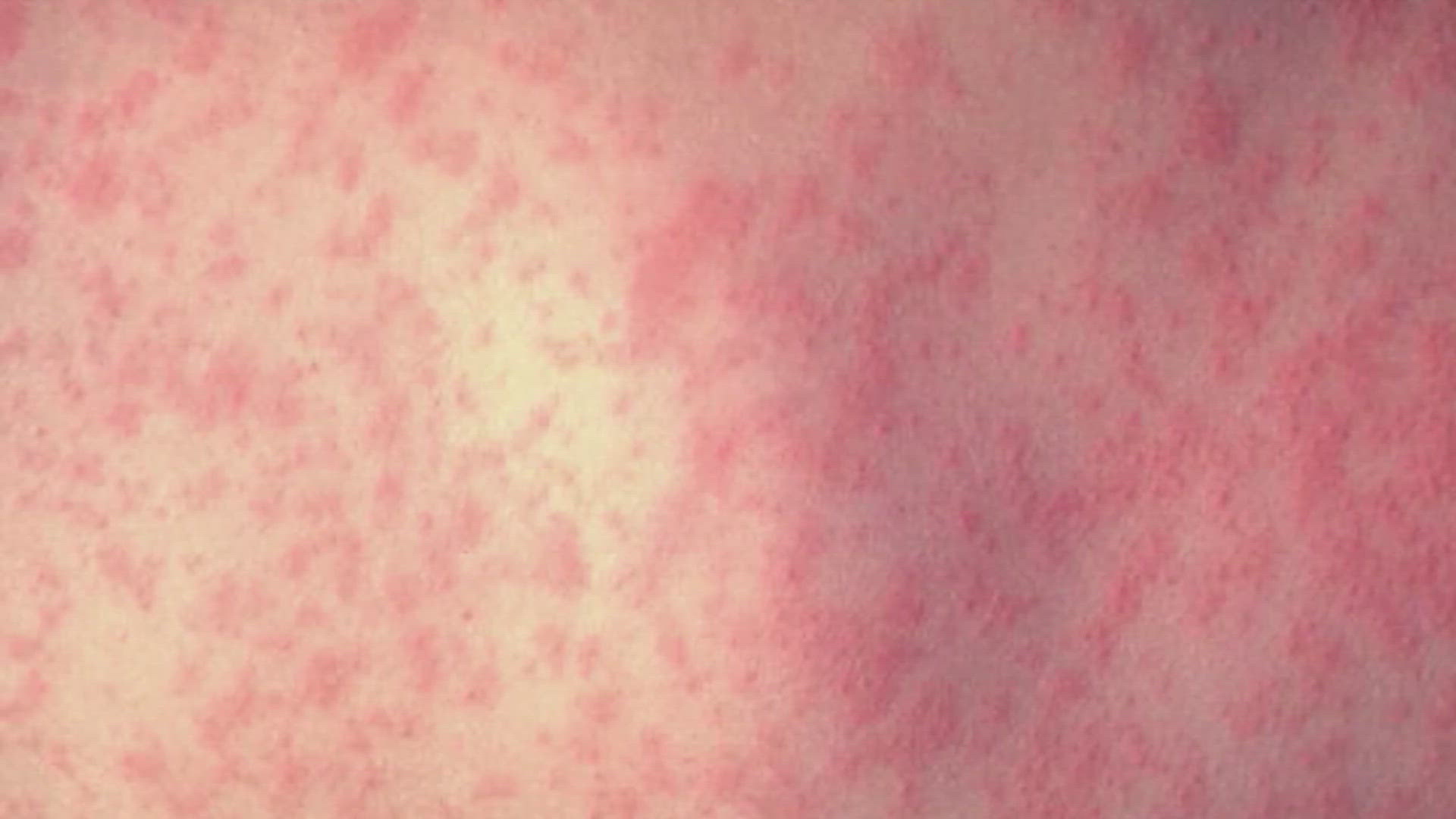 6 fully vaccinated people infected with measles in South Carolina outbreak