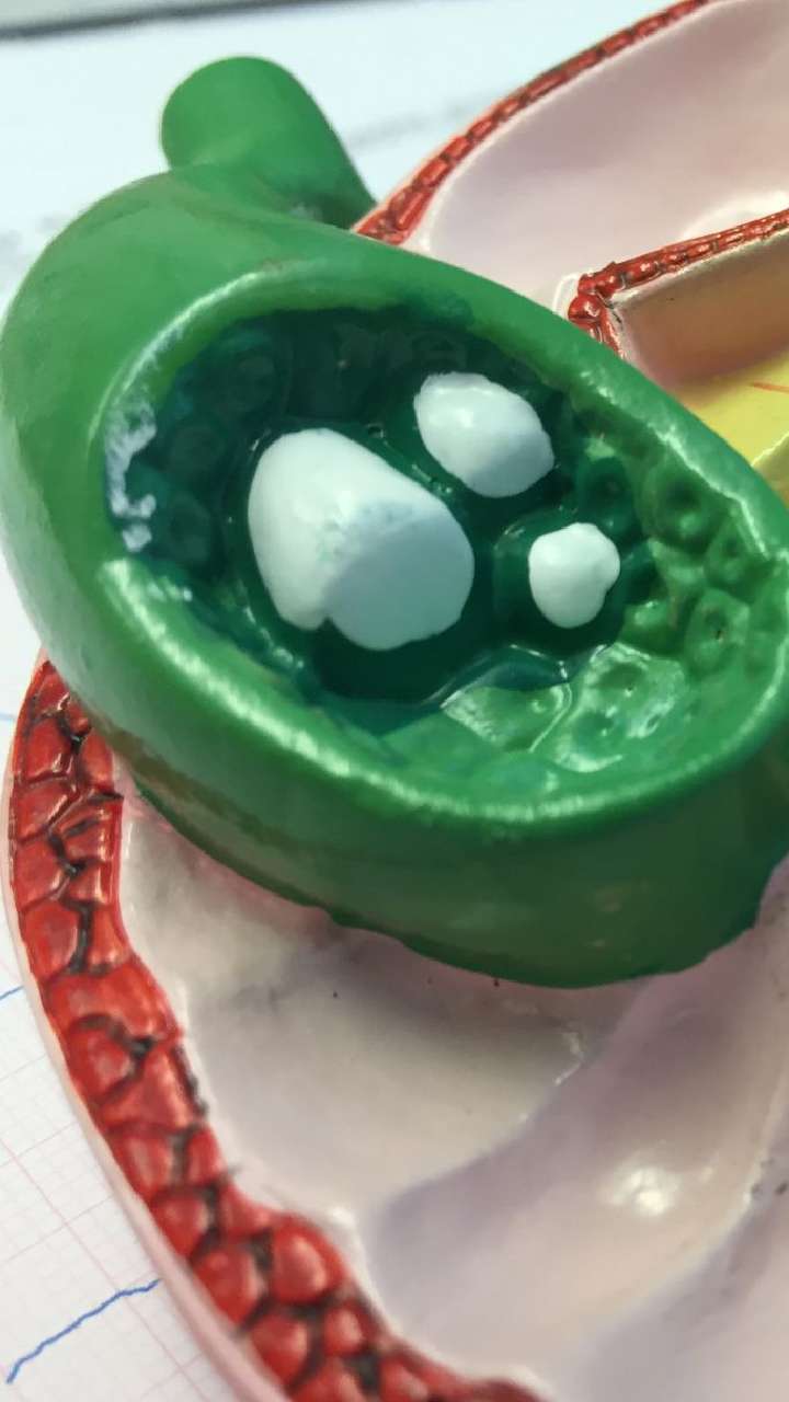 How To Treat Gallstones Without Surgery?