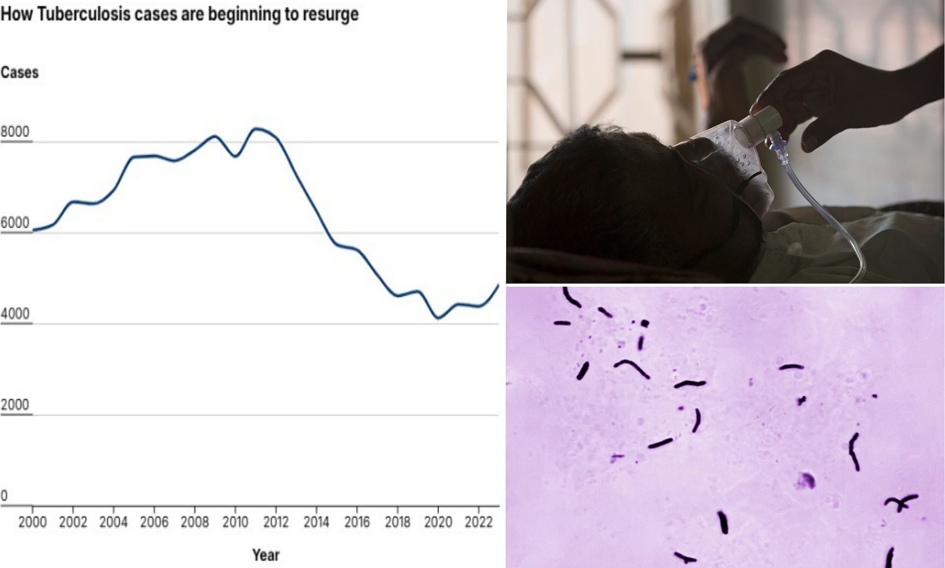 Victorian disease that makes patients cough up blood surging in UK