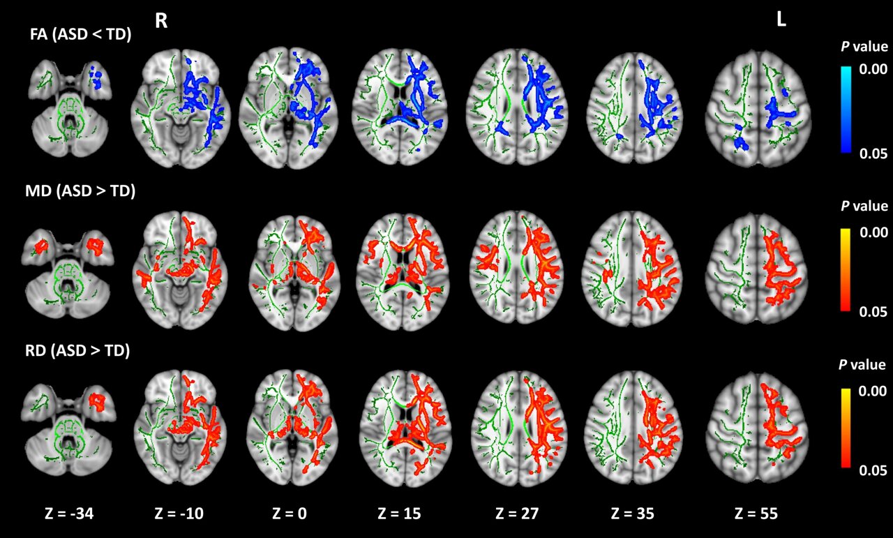 Decoding autism through neuroimaging: How alterations in brain ...