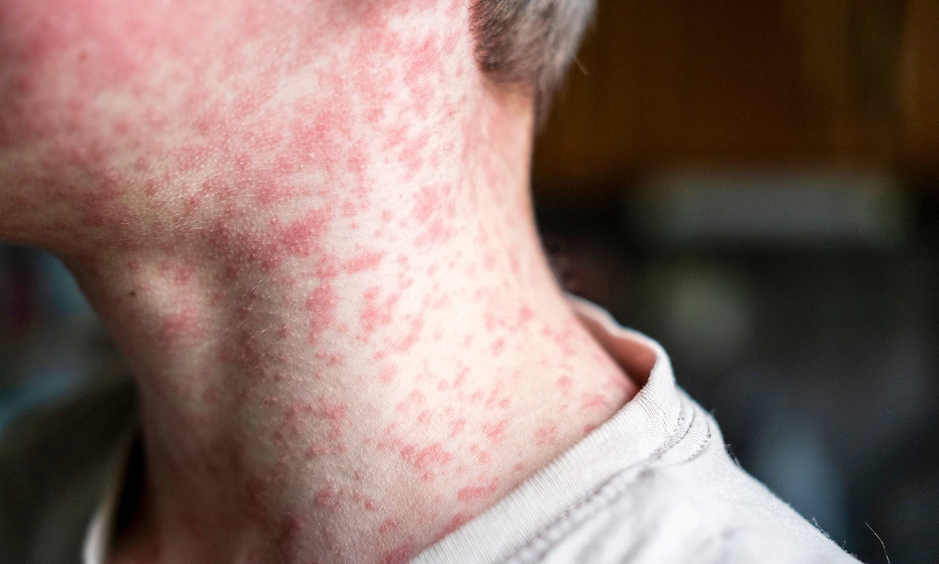 DC on red alert as 'world's most infectious disease' is detected