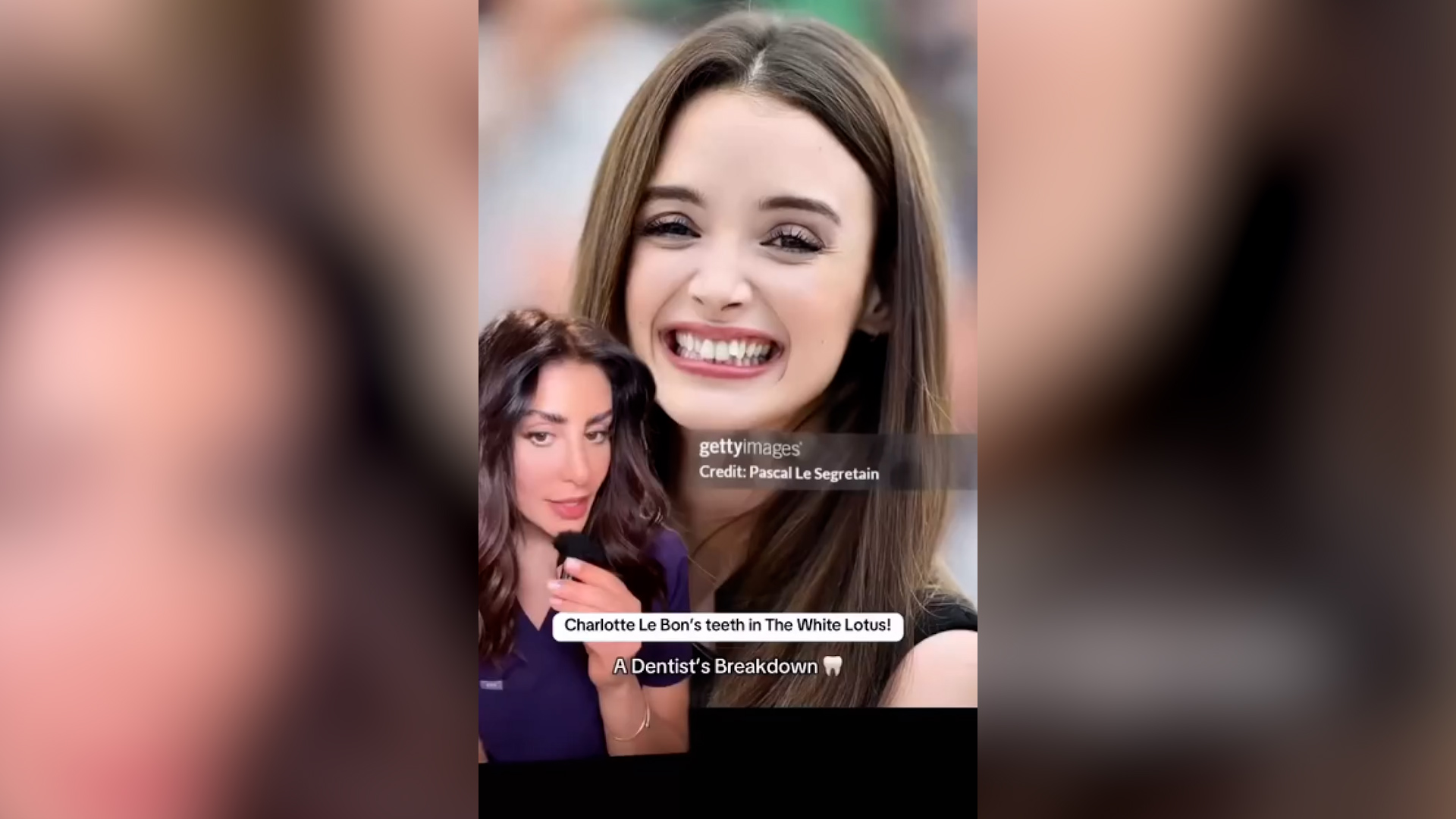 Dentist Responds To The 'Perfectly Imperfect Teeth' On White Lotus