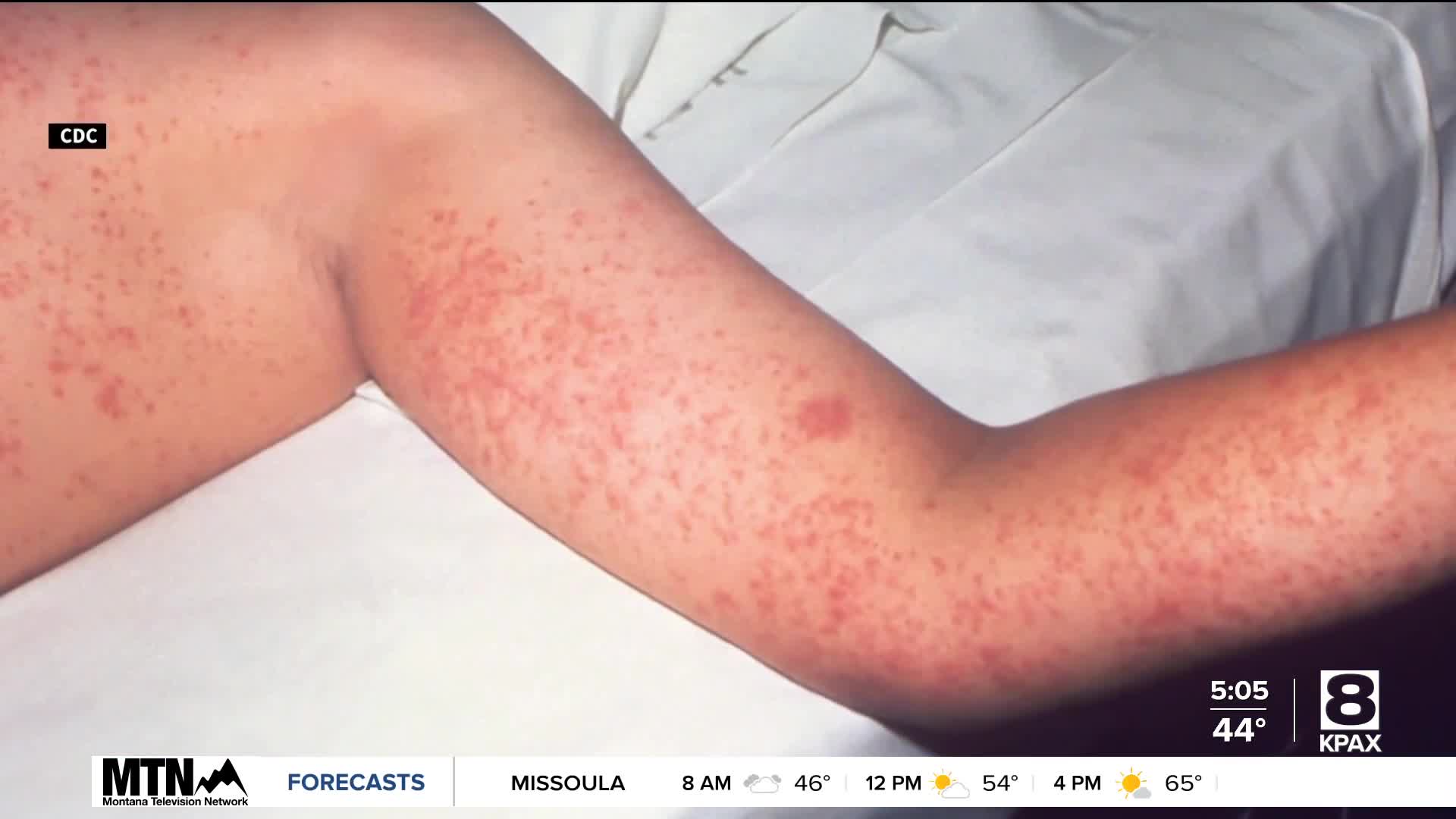 Montana officials monitoring U.S. measles outbreak