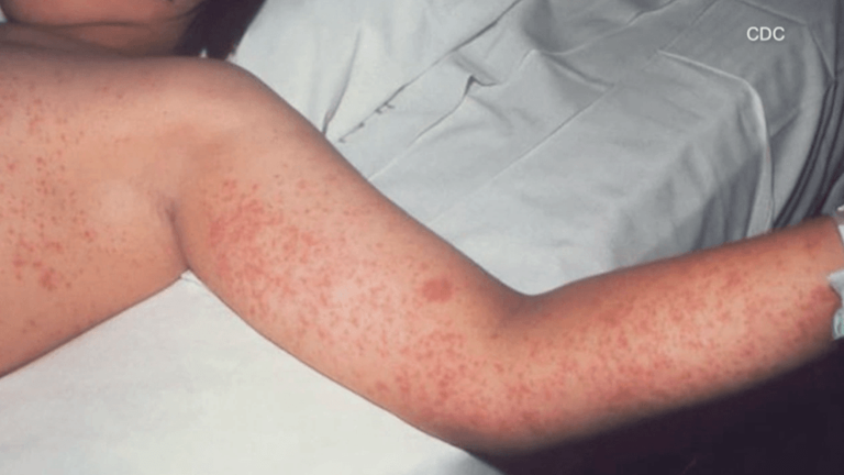 Long-term dangers of the measles, Dr warns side effects can show 10 ...