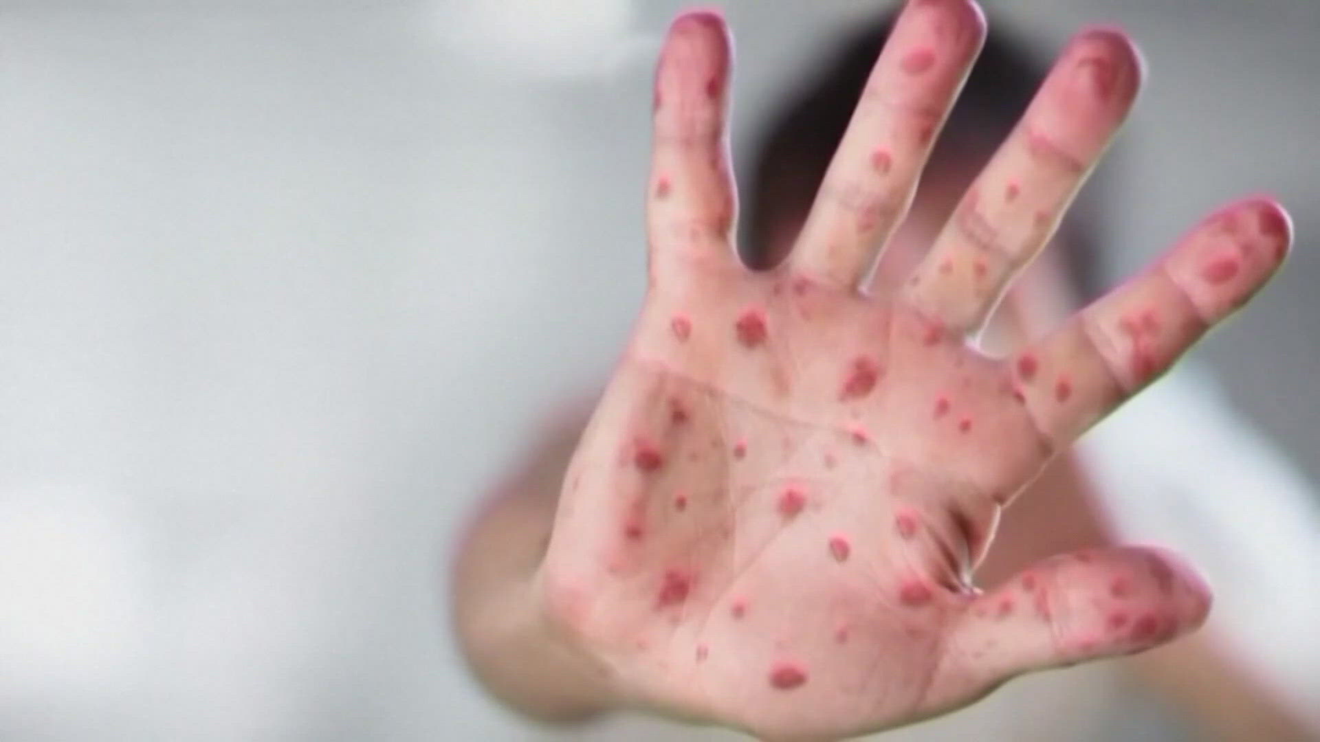 Measles cases up to 327 in west Texas
