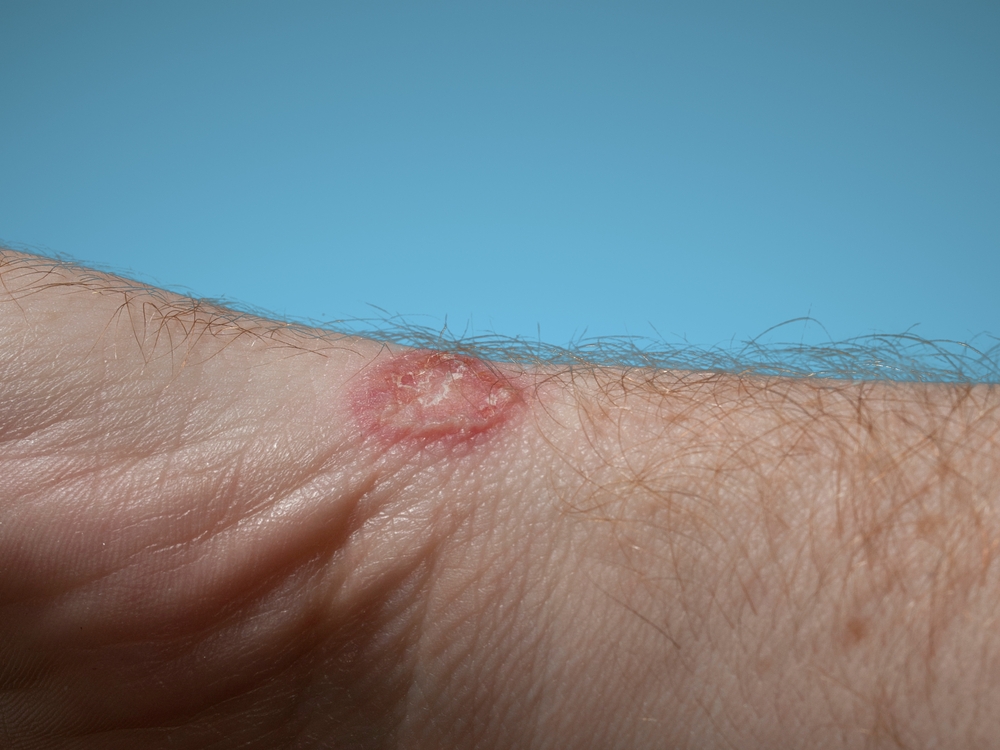 What Is Tinea Manuum? (Causes, Treatment, and More)