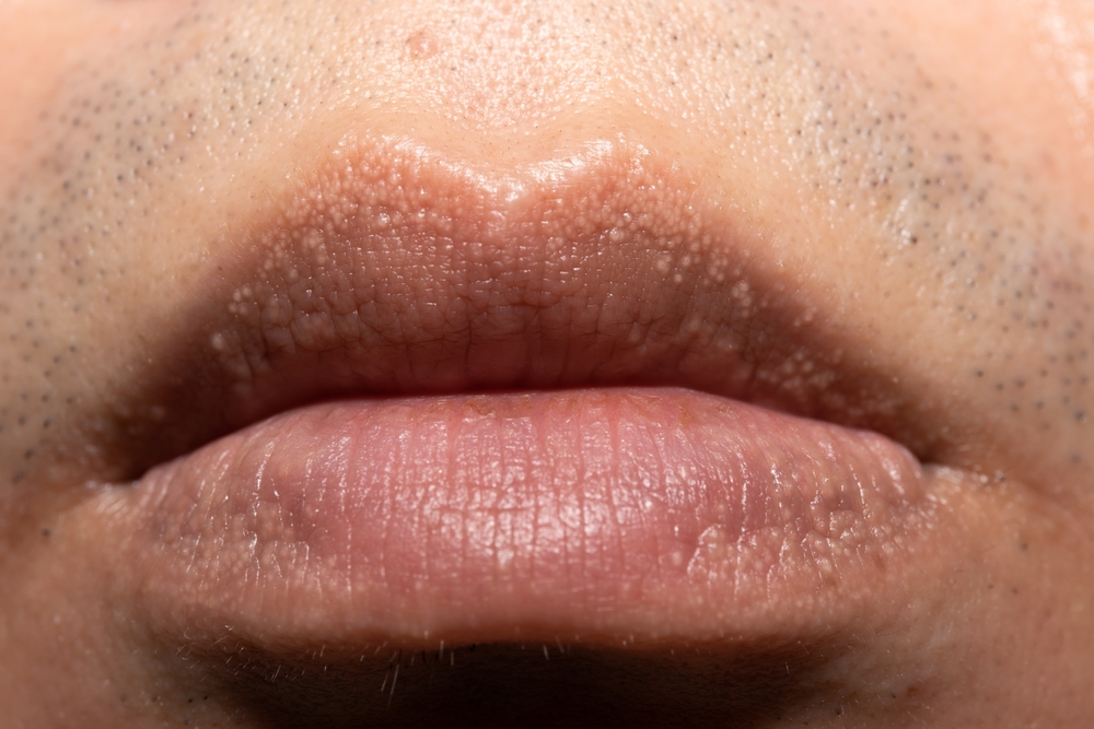 Reasons people get ‘white bumps’ on lips and other areas